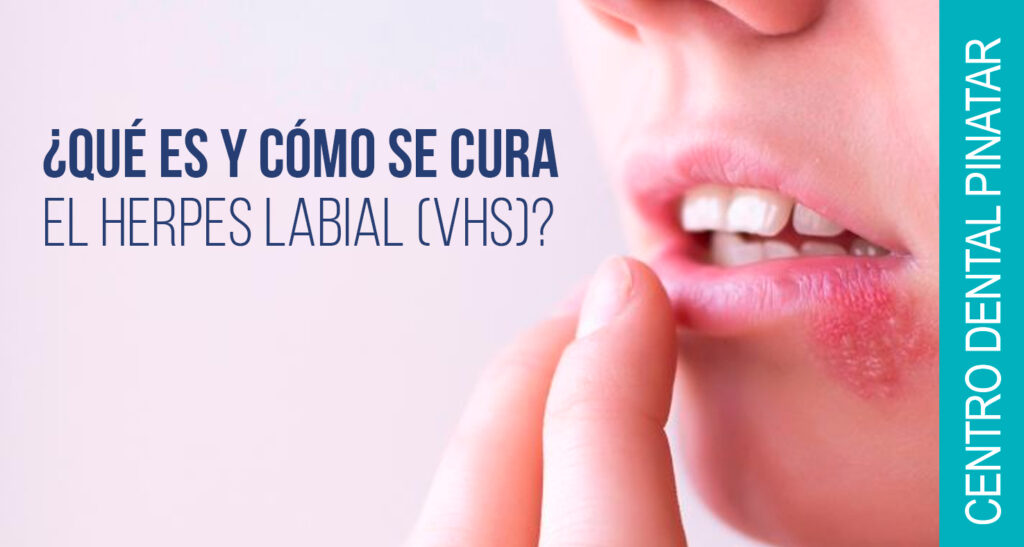 ¿Qué es y cómo se cura el herpes labial (vhs)? - Centro Dental Pinatar